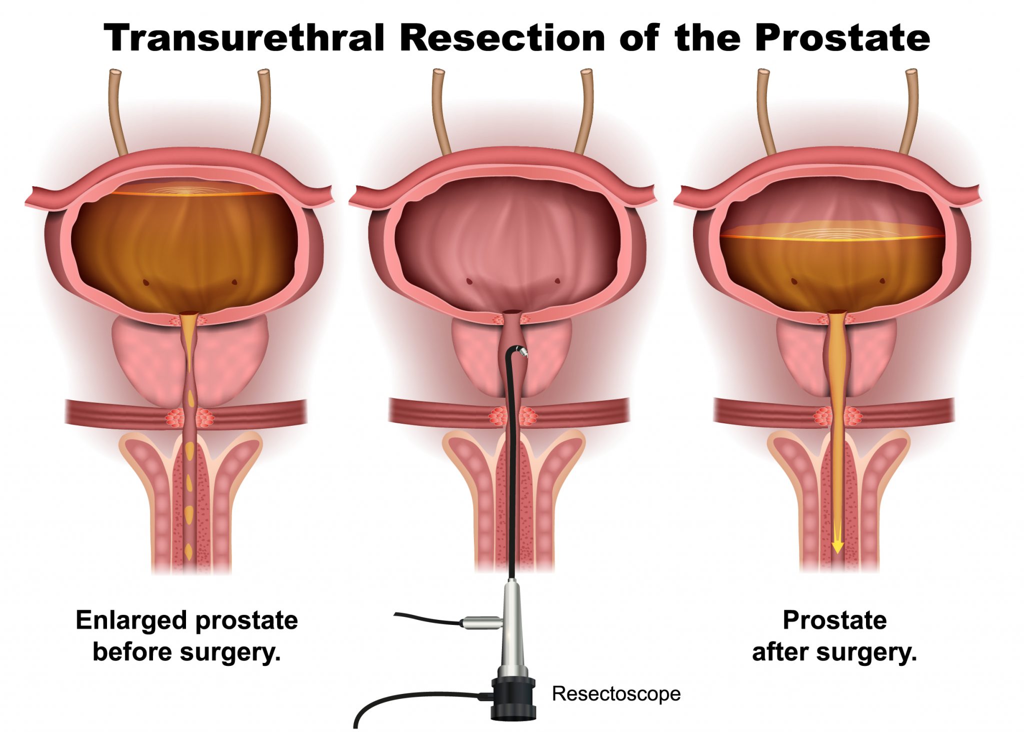 Surgeries And Therapies For Bph Feifer Urology